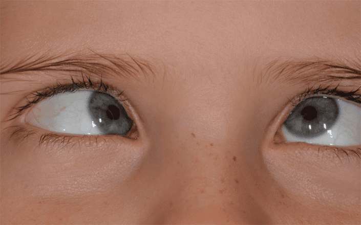 EYE-Q INDIA: Crossed Eye (तिरछी आंखें) causes and treatment