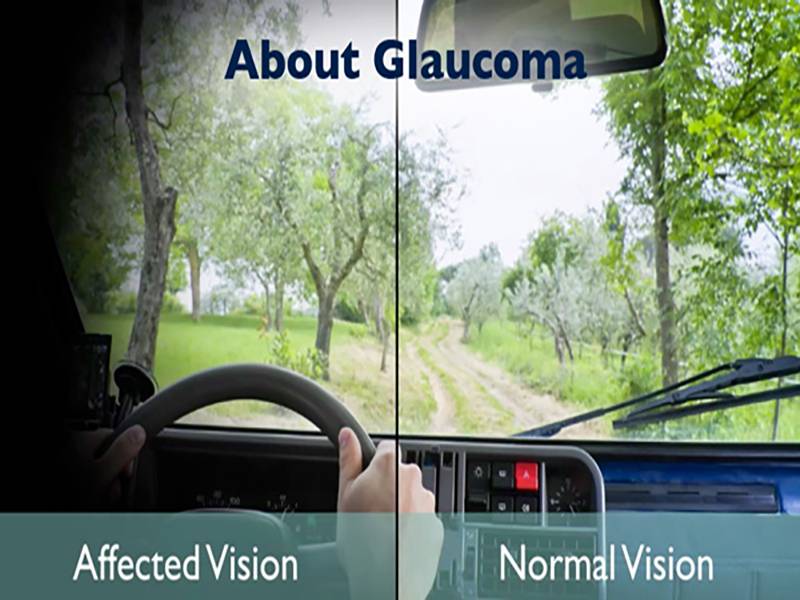 Gloucoma: Symptoms, Causes, Treatment, ग्लूकोमा, काला मोतिया