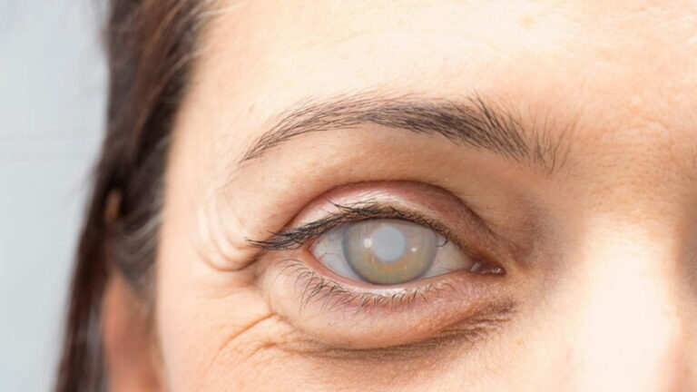 Dos And Donts Before Cataract Surgery