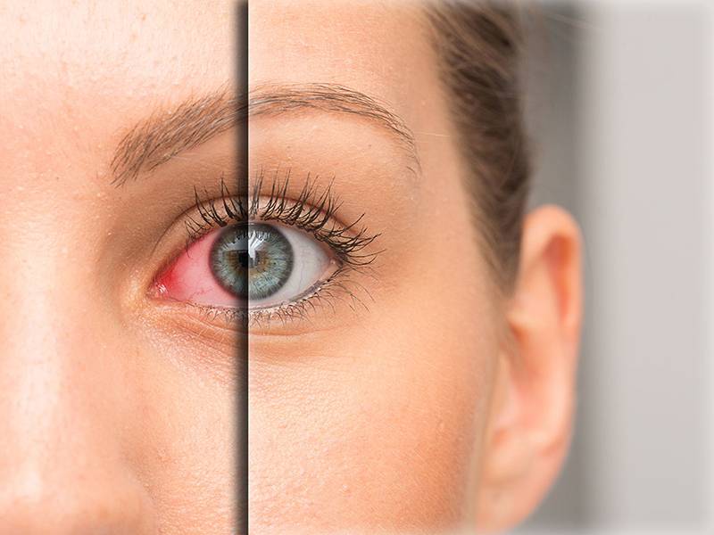 Seeing Clearly: Understanding Dry Eye and How to Find Relief