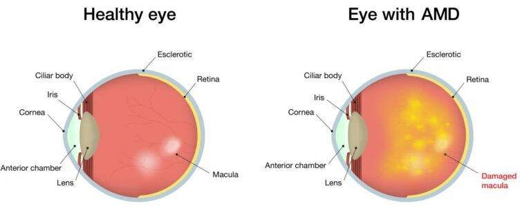 Age-Related Macular Degeneration (AMD): Symptoms, Diagnosis & Treatment